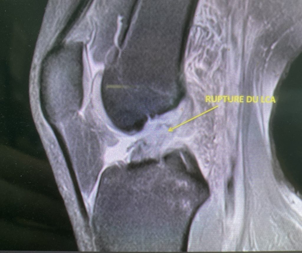 Ligament Croisé Antérieur - Dr Fabien Ros, chirurgien orthopédique à ...