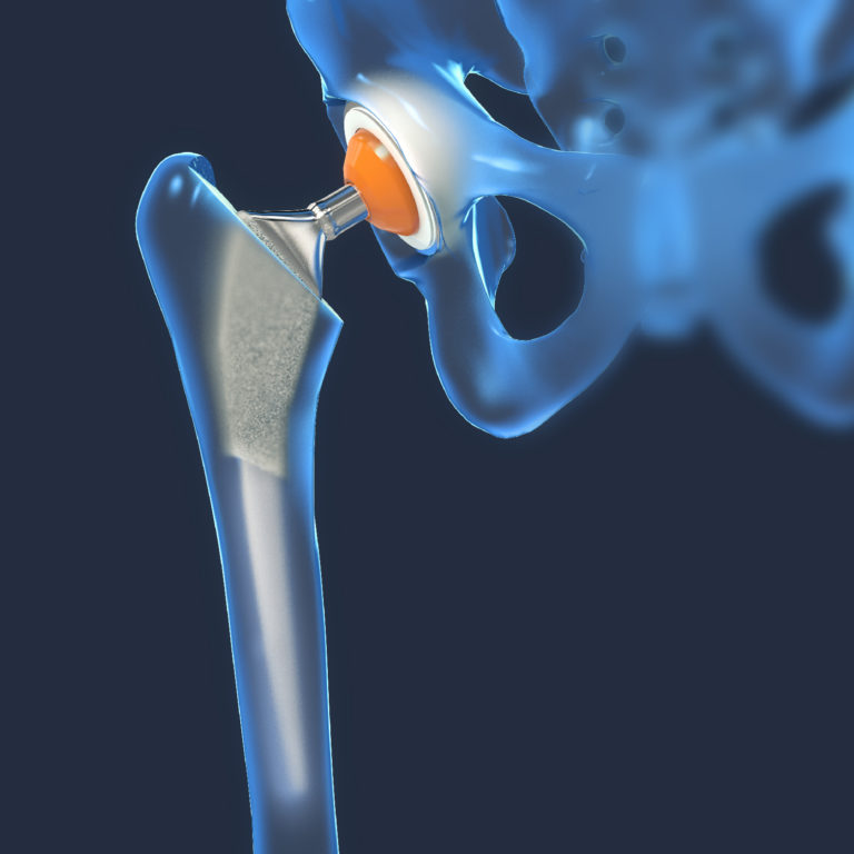 Prothèse de Hanche - Dr Fabien Ros, chirurgien orthopédique à Aubagne
